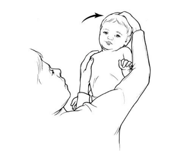 What Is Torticollis and How Is It Treated? - Milestone Pediatric Therapy